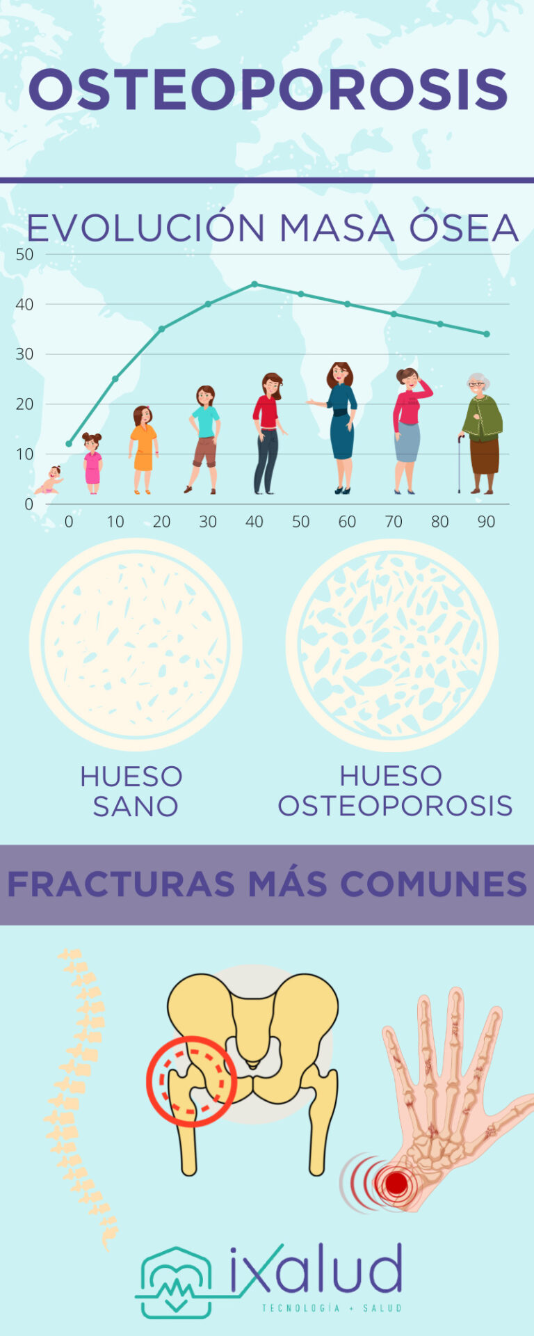 Osteoporosis S ntomas Y Tratamiento Ixalud es Osteoporosis S ntomas Y Tratamiento Ixalud es