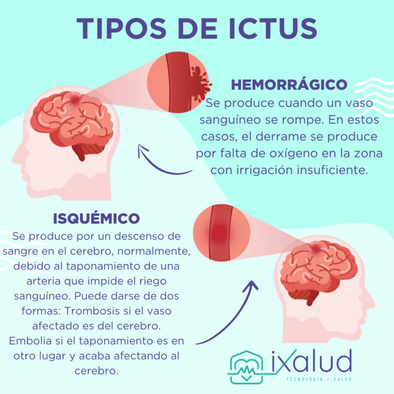 Secuelas tras sufrir un ictus | ixalud.es