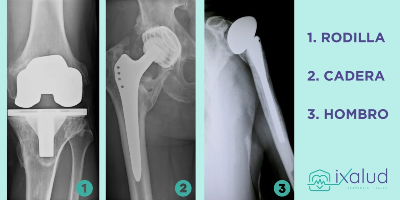 ¿Qué es una prótesis articular y cómo se rehabilita? | ixalud.es