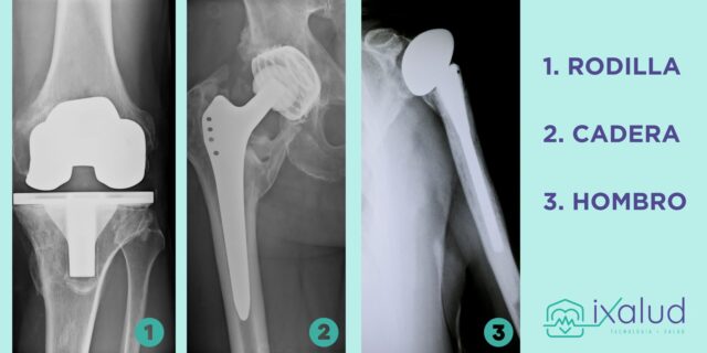 ¿Qué es una prótesis articular y cómo se rehabilita? | ixalud.es